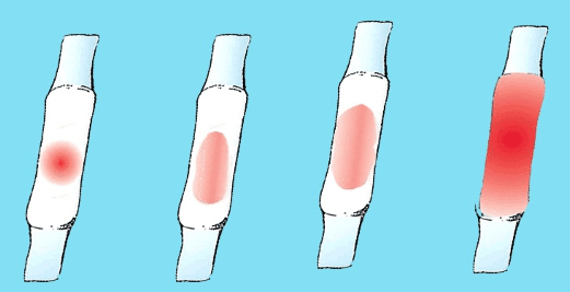 Nidação ou Menstruação?