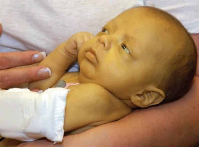 Icterícia Neonatal: o que é, causas, como ocorre, tipos e valores de ... Icterícia Neonatal: o que é, causas, como ocorre, tipos e valores de ...