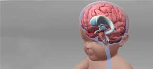 Hidrocefalia em Bebê: sintomas, causas, tratamento
